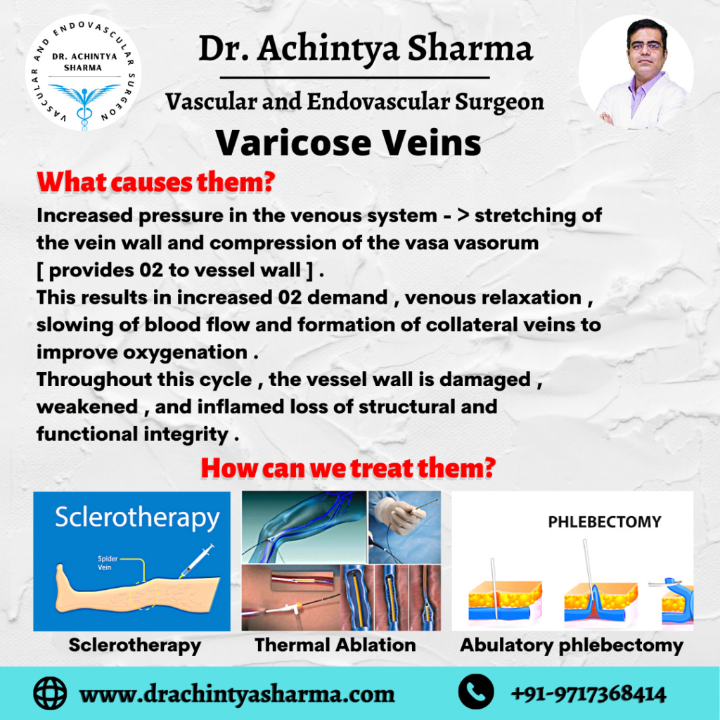Have you been looking for the Best Varicose Vein Treatment?