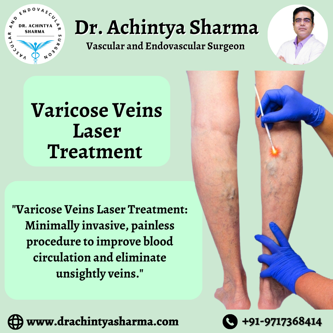 Laser treatment for varicose veins