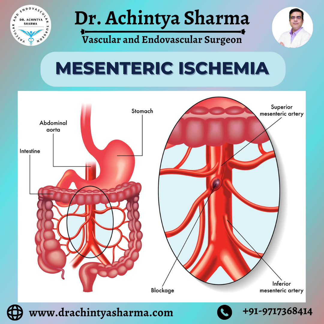 Mesenteric Artery Disease Symptoms
