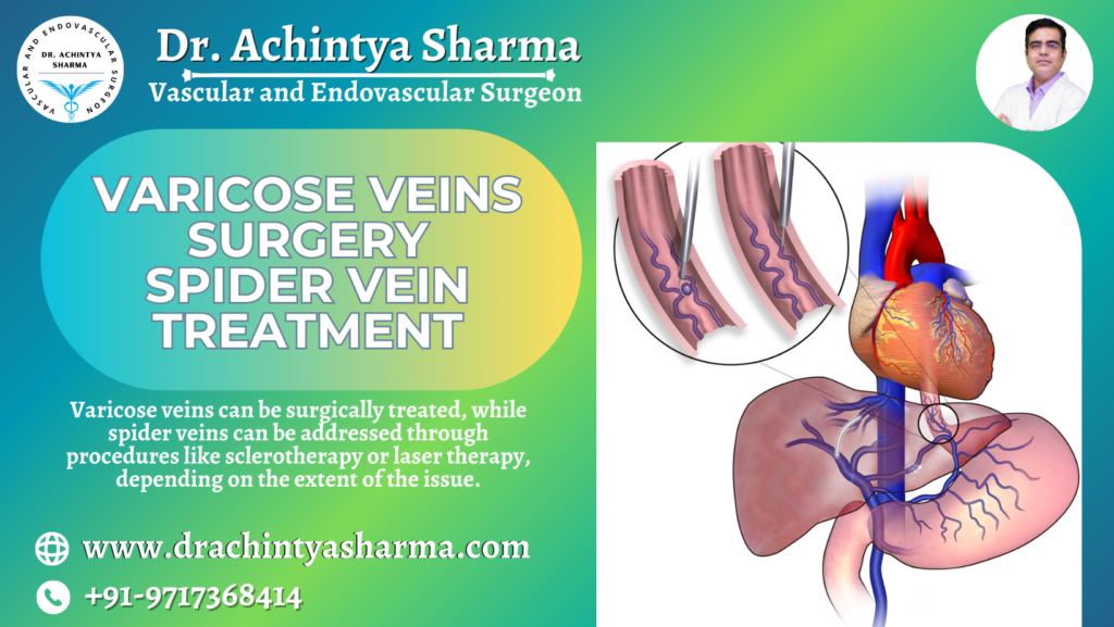 Guide to varicose veins surgery spider vein treatment.