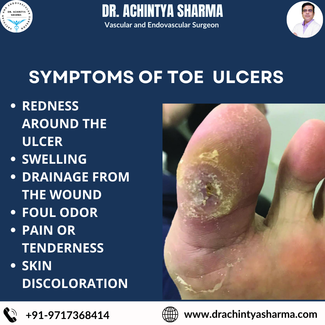 Diabetes Foot Care: Treating and Preventing Ulcers on the Toe