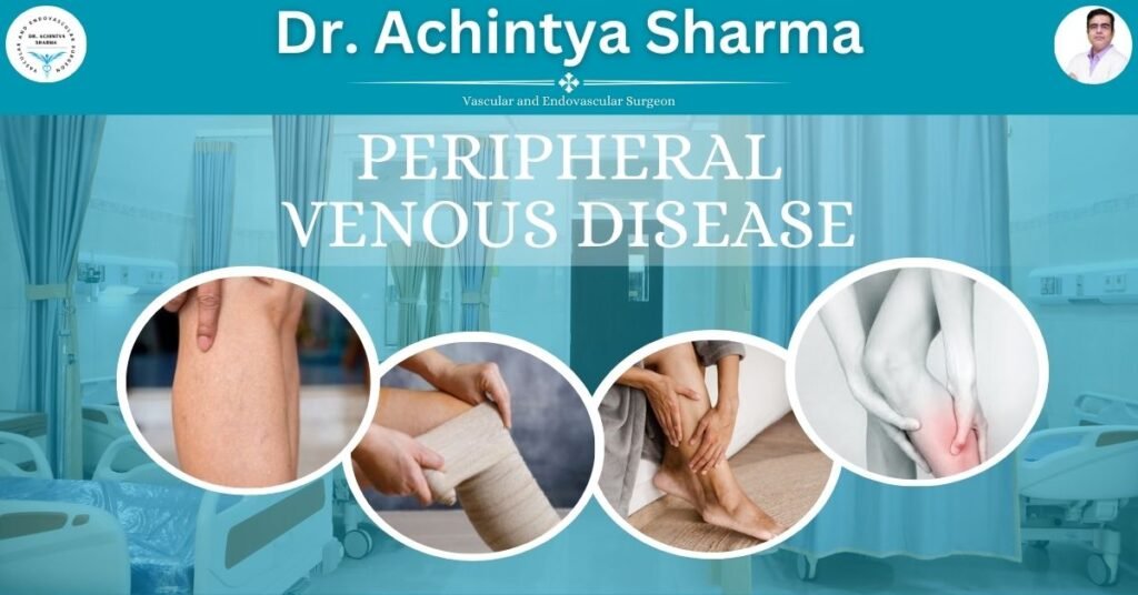 Peripheral Venous Disease: Symptoms, Causes, Treatments