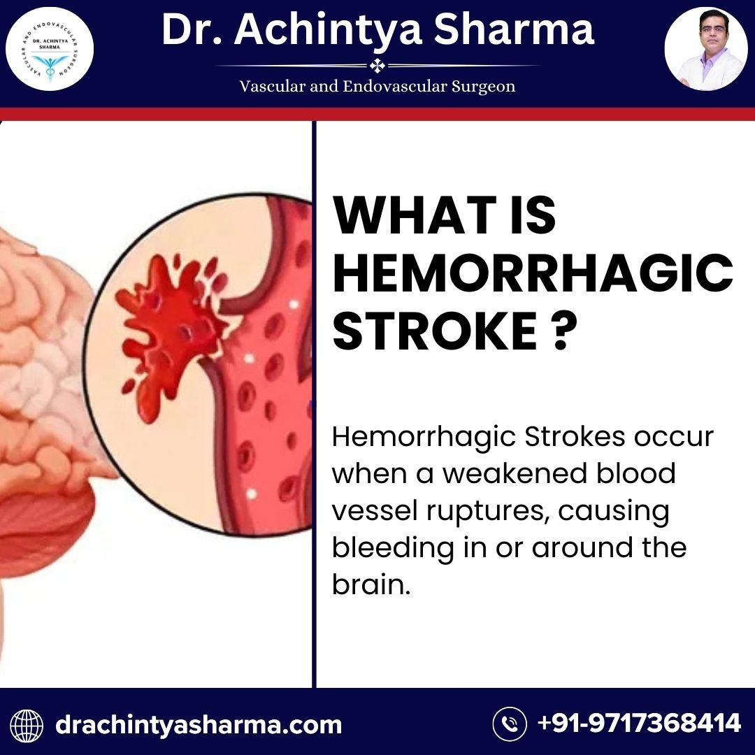 What are the 5 different types of Strokes? | Dr. Achintya Sharma