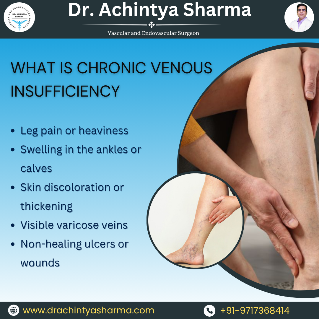 Chronic Venous Insufficiency Treatment in Delhi: Advanced Care by Dr ...