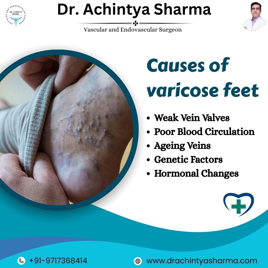 Varicose Feet: Causes, Symptoms & Effective Treatment Options